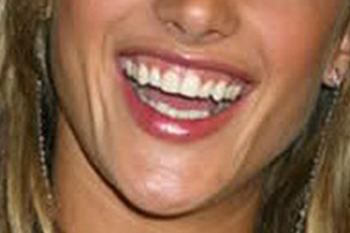 How To Embrace Your Smile's Perfect Imperfections