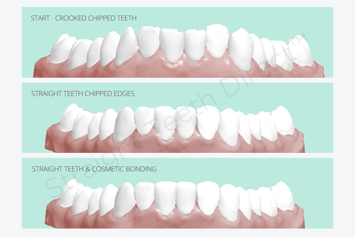 Crooked teeth illusion. How your teeth shape play a crucial role
