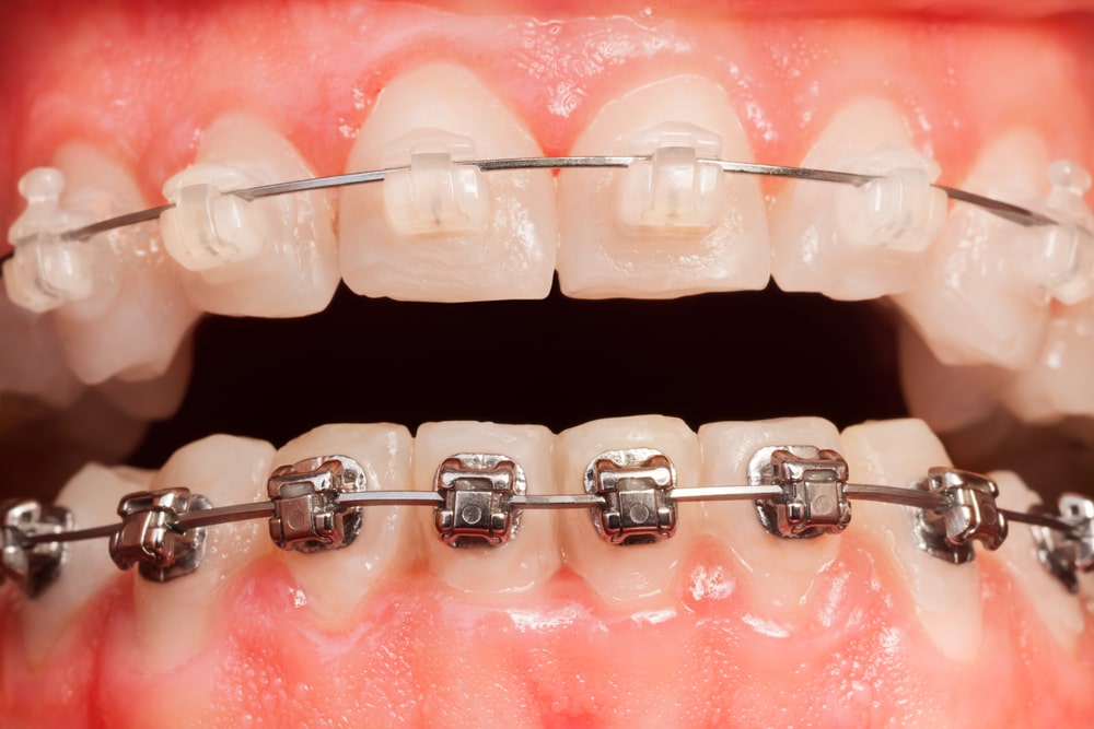 Braces - fixed or removable? 8 points you need to know